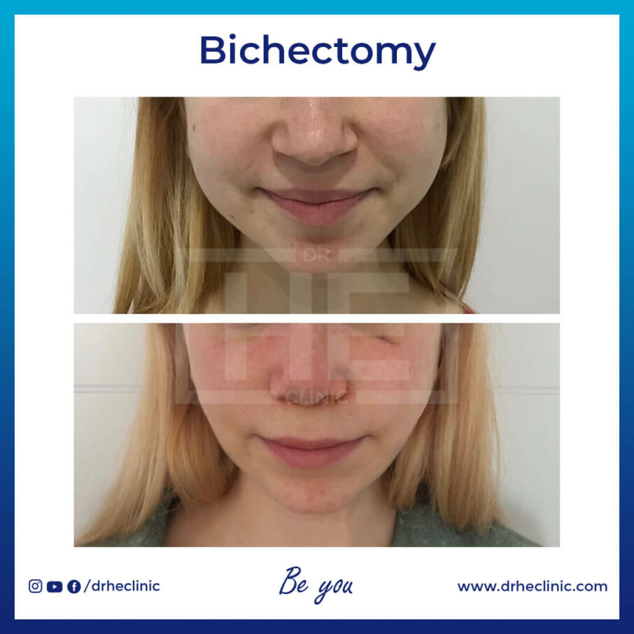 Bishectomy in Istanbul,Turkey Cost & Reviews | Dr. HE Clinic