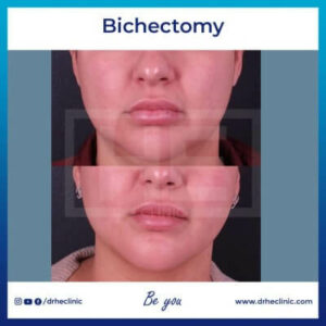 Bishectomy Cost in Turkey